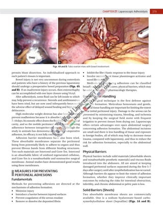 Laparoscopic Adhesiolysis | PDF