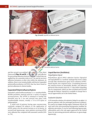 Laparoscopic Adhesiolysis | PDF