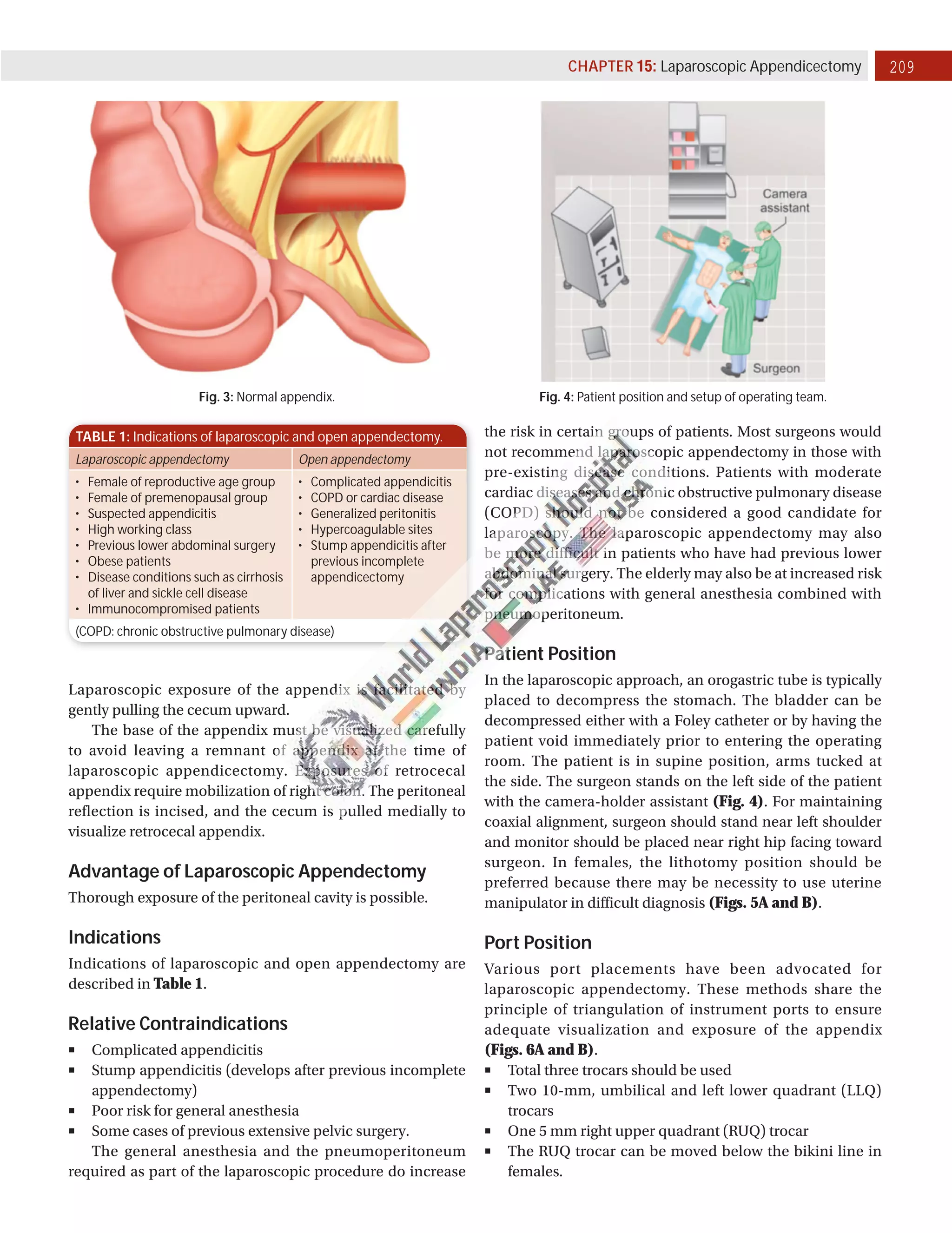 Laparoscopic Appendicectomy | PDF