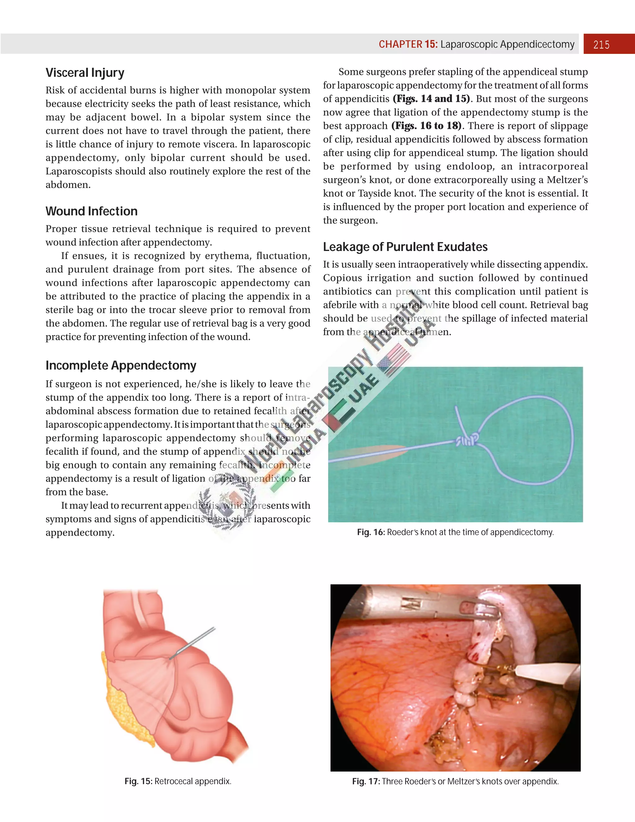 Laparoscopic Appendicectomy | PDF