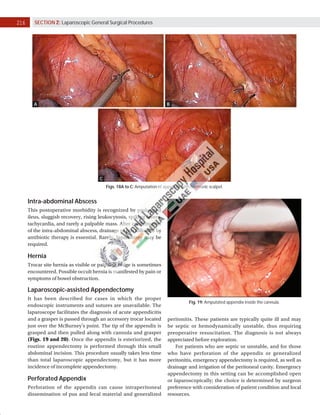 Laparoscopic Appendicectomy | PDF | Digestive Disorders | Diseases and Conditions