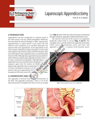 Laparoscopic Appendicectomy at World Laparoscopy Hospital | PDF