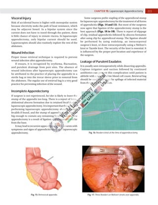 Laparoscopic Appendicectomy at World Laparoscopy Hospital | PDF