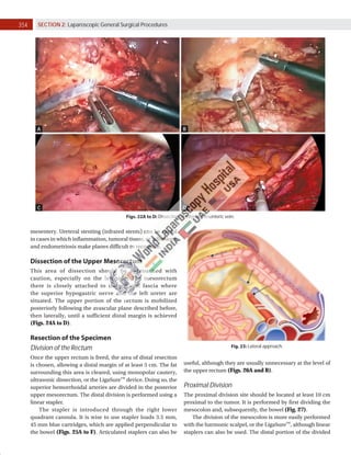 Laparoscopic Colorectal Surgery | PDF
