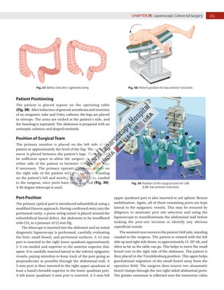 Laparoscopic Colorectal Surgery | PDF