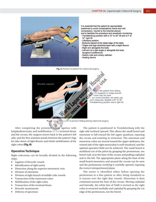 Laparoscopic Colorectal Surgery | PDF