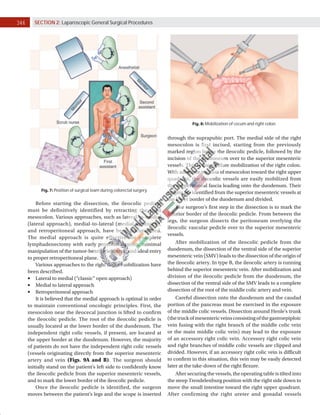 Laparoscopic Colorectal Surgery | PDF