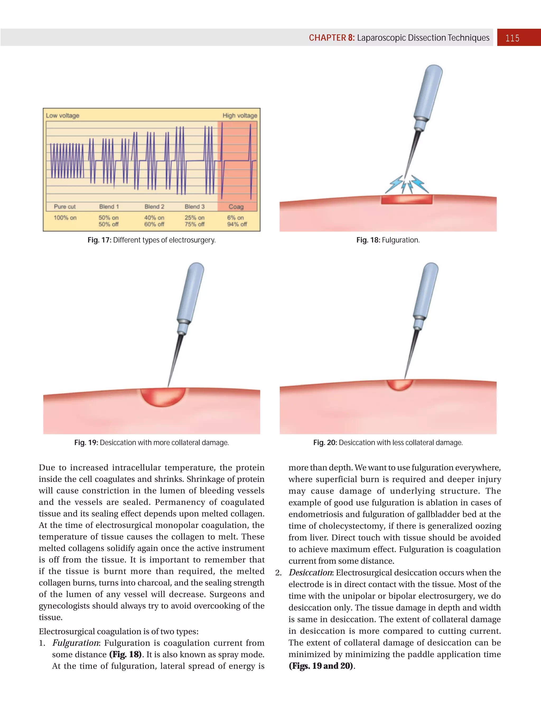 Laparoscopic Dissection Techniques | PDF