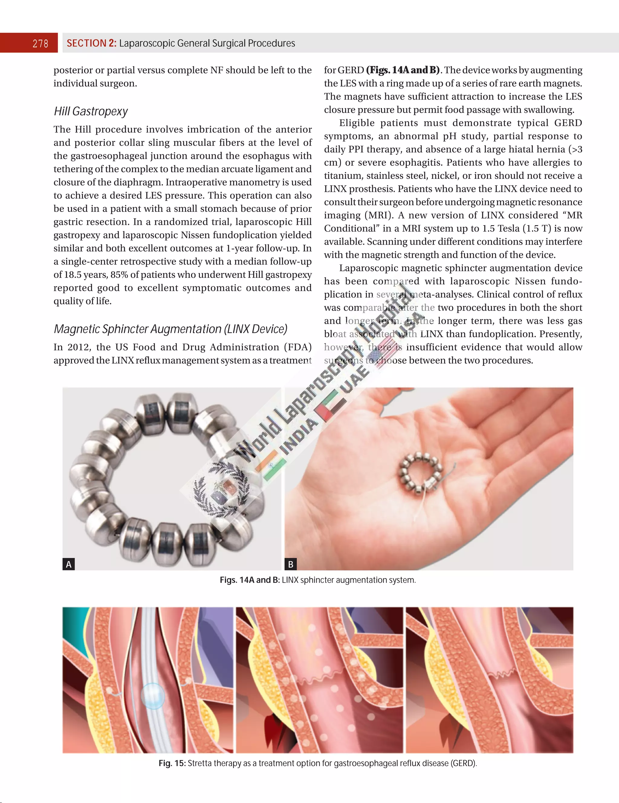 Laparoscopic Fundoplication | PDF