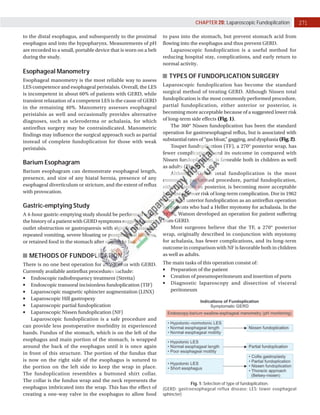 Laparoscopic Fundoplication | PDF