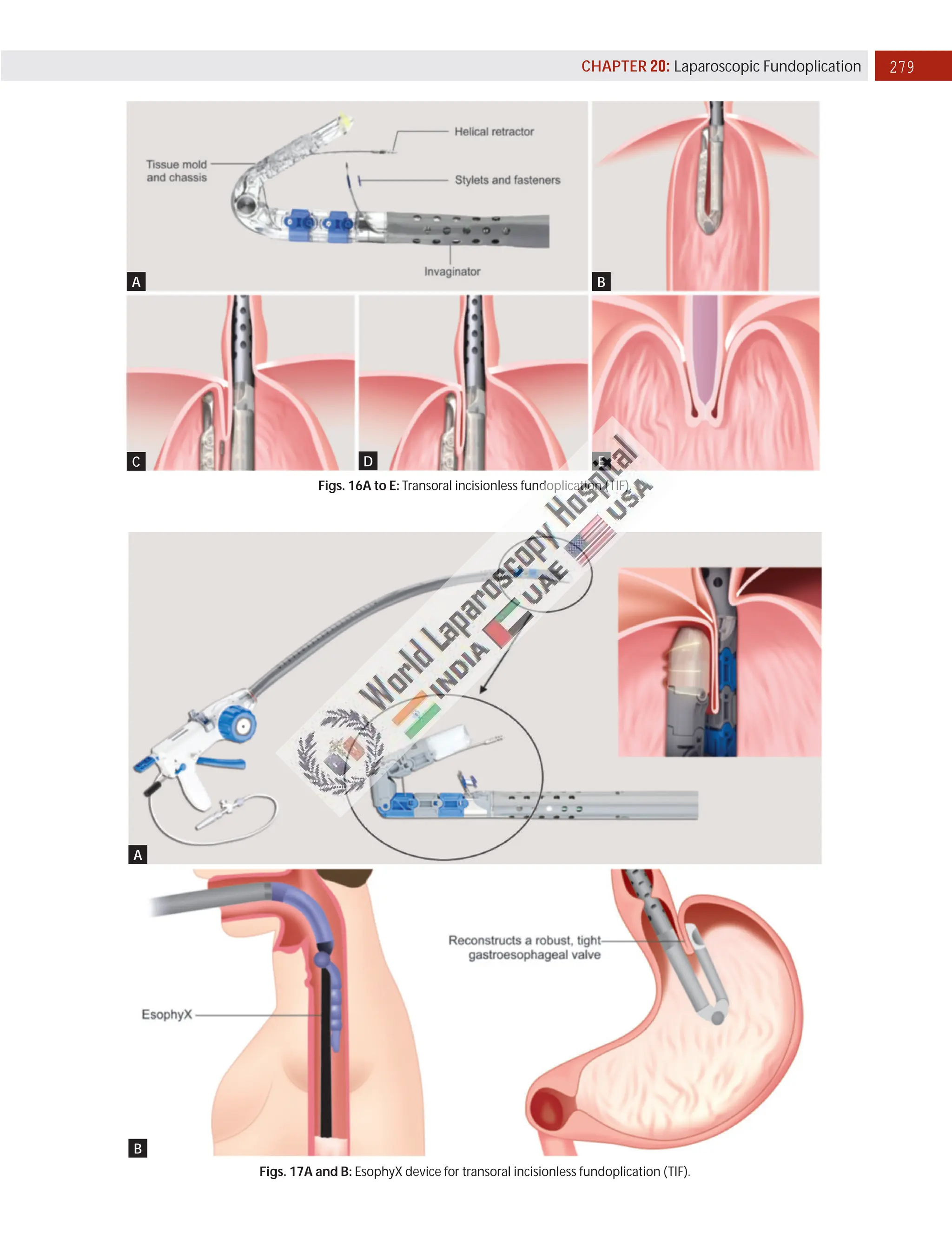 Laparoscopic Fundoplication at World Laparoscopy Hospital | PDF