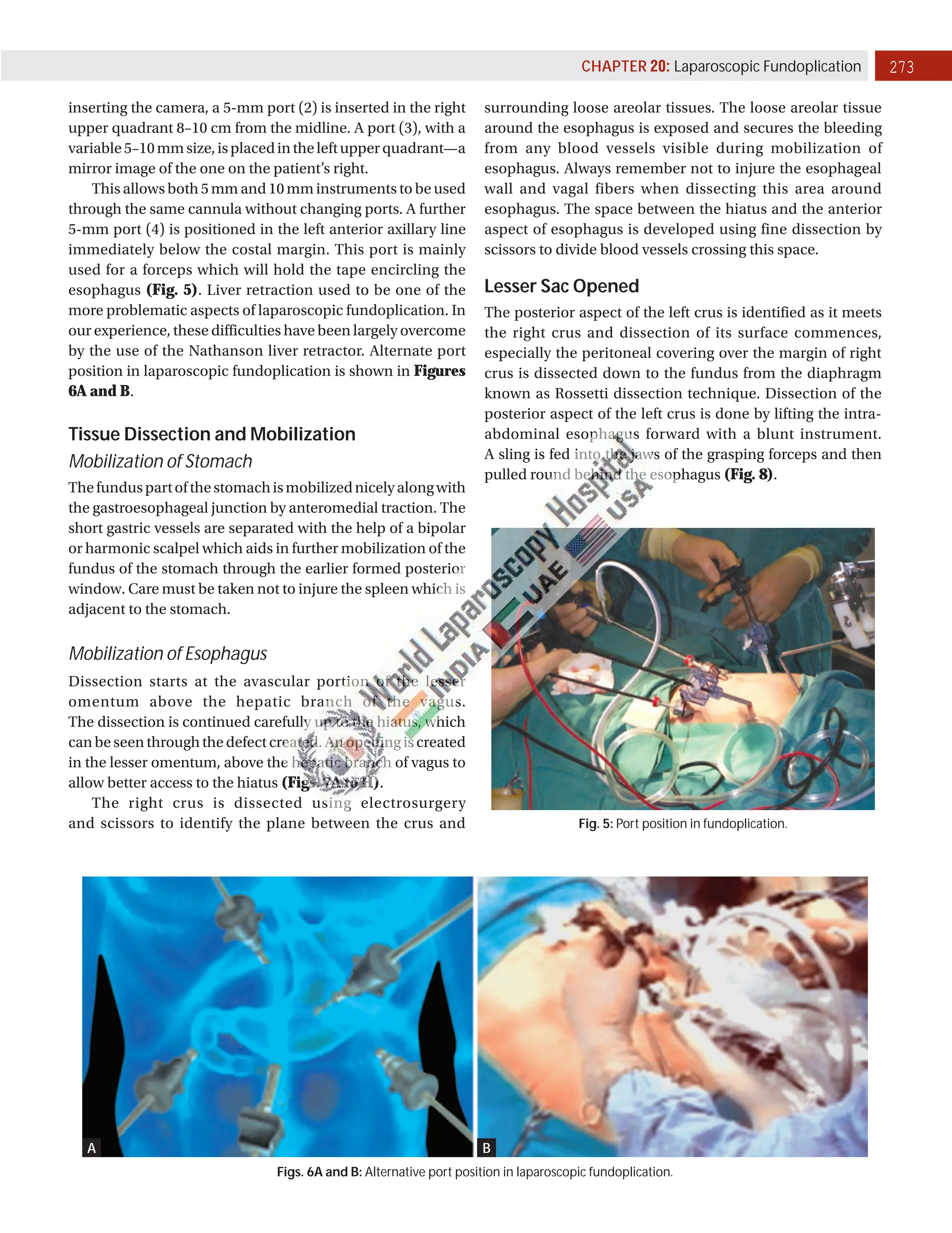 Laparoscopic Fundoplication at World Laparoscopy Hospital | PDF