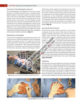 Laparoscopic Hysterectomy | PDF | Pregnancy | Reproductive Health