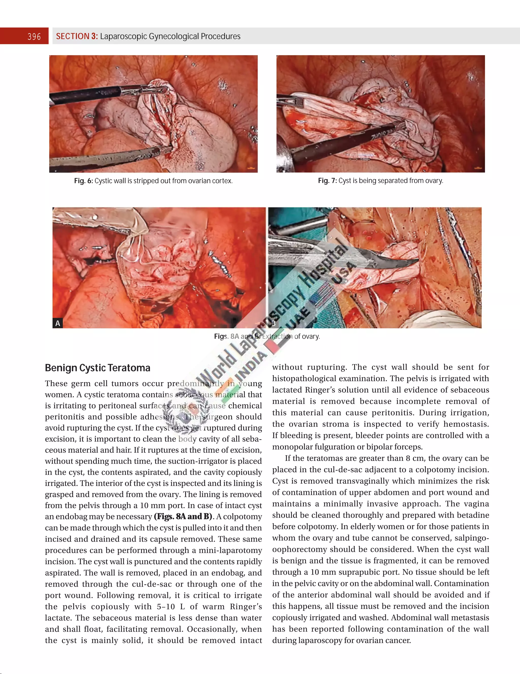 Laparoscopic Ovarian Surgery | PDF