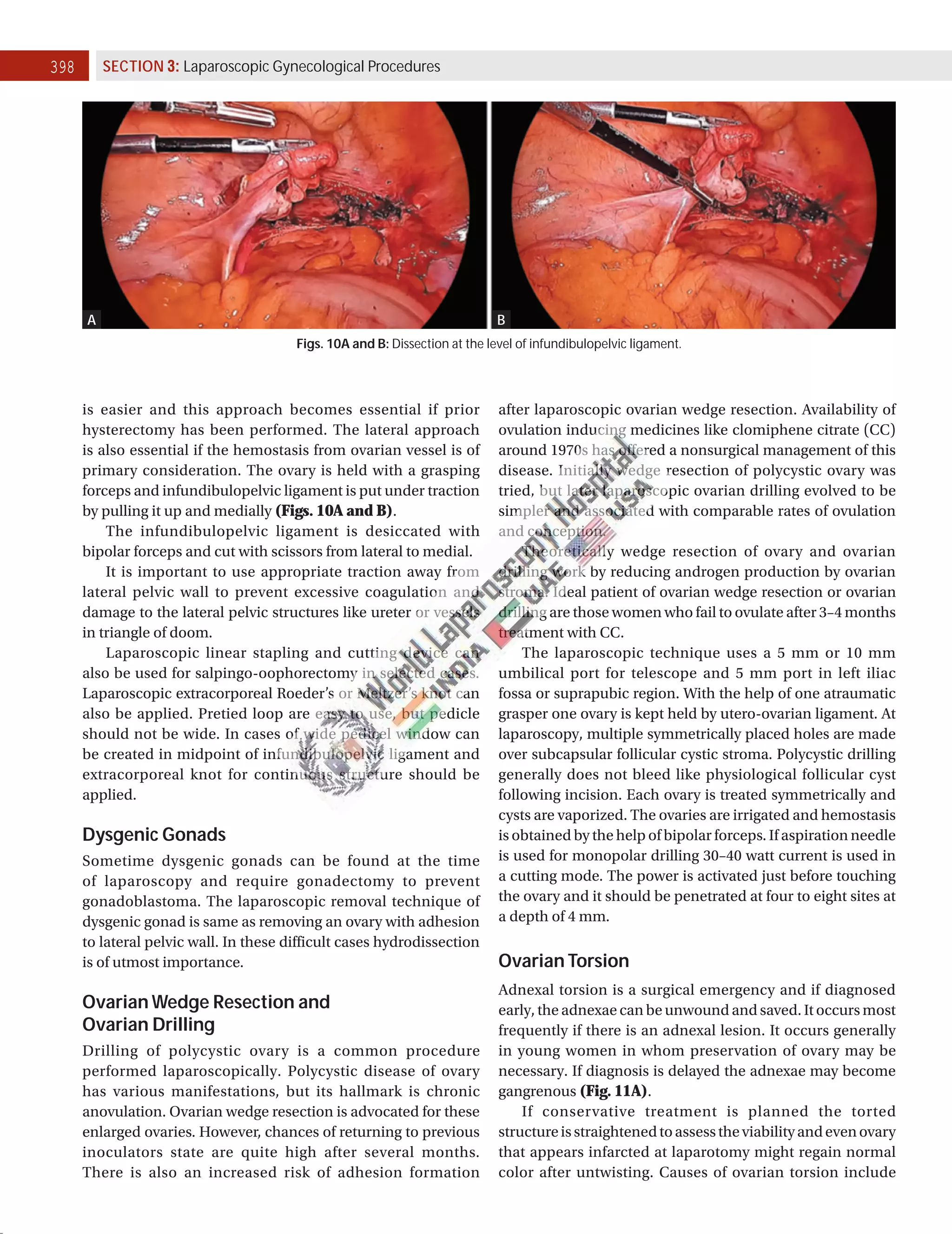Laparoscopic Ovarian Surgery | PDF