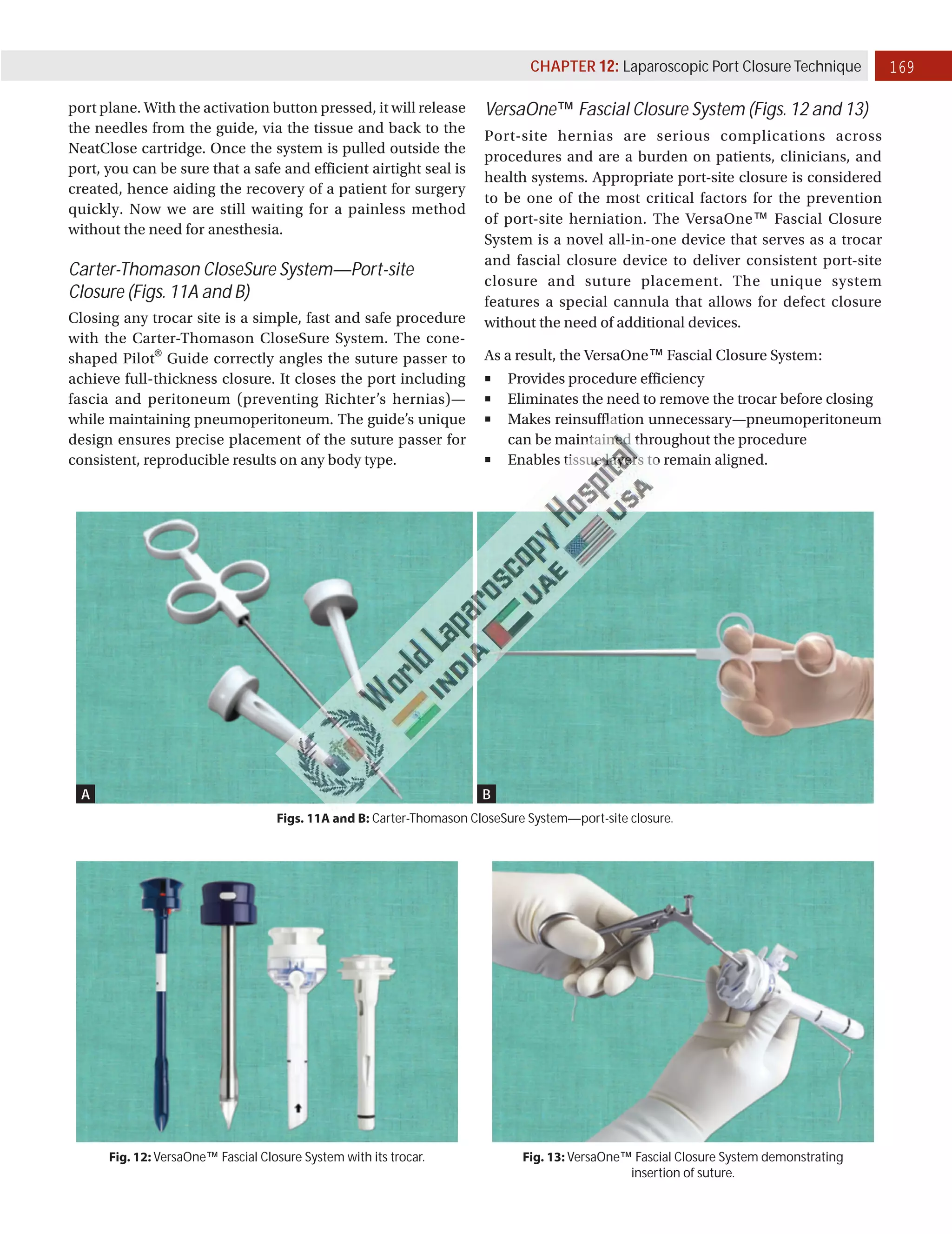 Laparoscopic Port Closure Technique | PDF