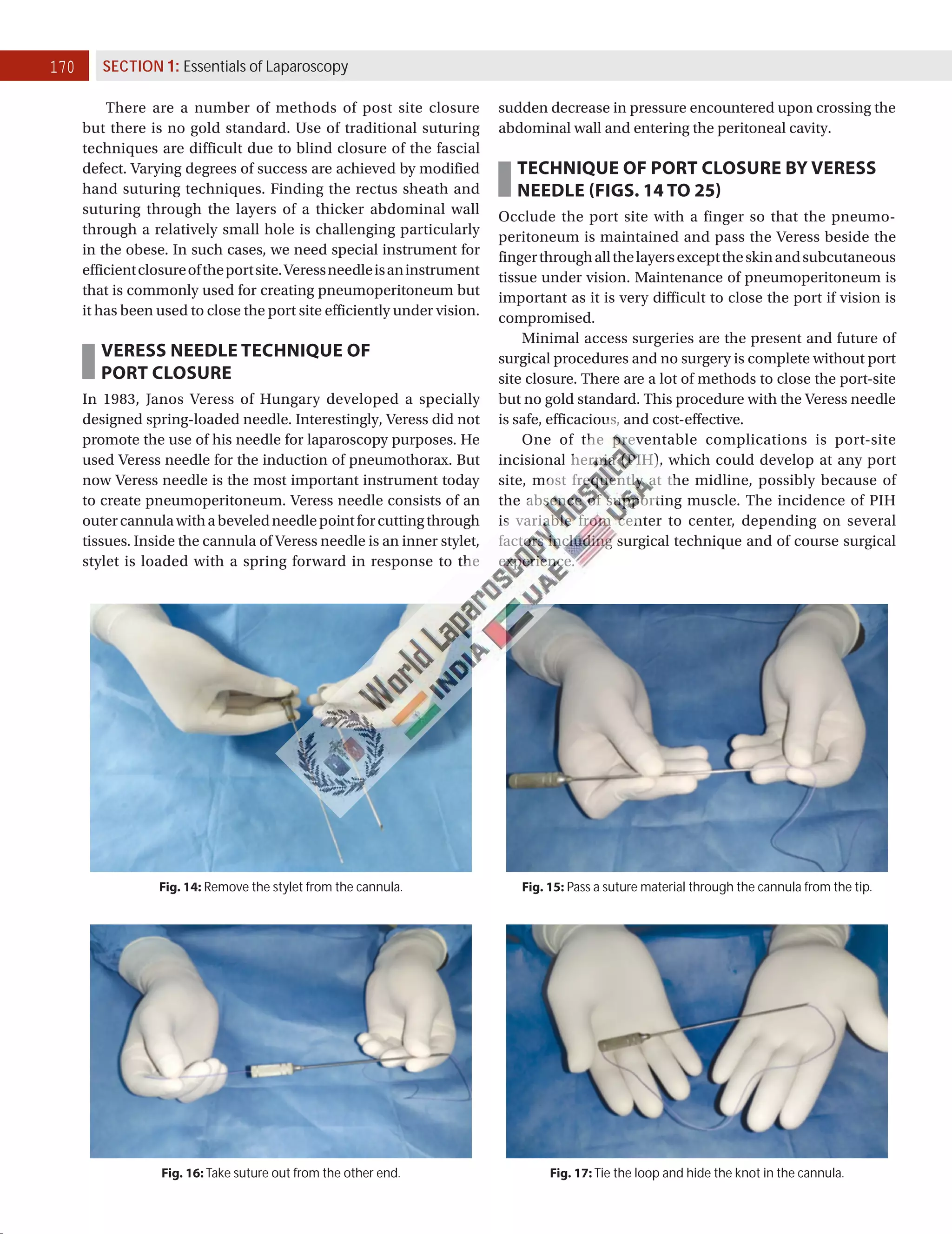 Laparoscopic Port Closure Technique | PDF