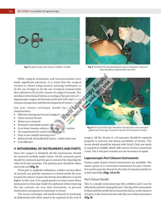 Laparoscopic Port Closure Technique | PDF