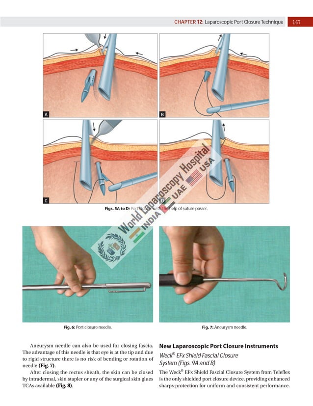 Laparoscopic Port Closure Technique | PDF