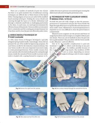 Laparoscopic Port Closure Technique | PDF