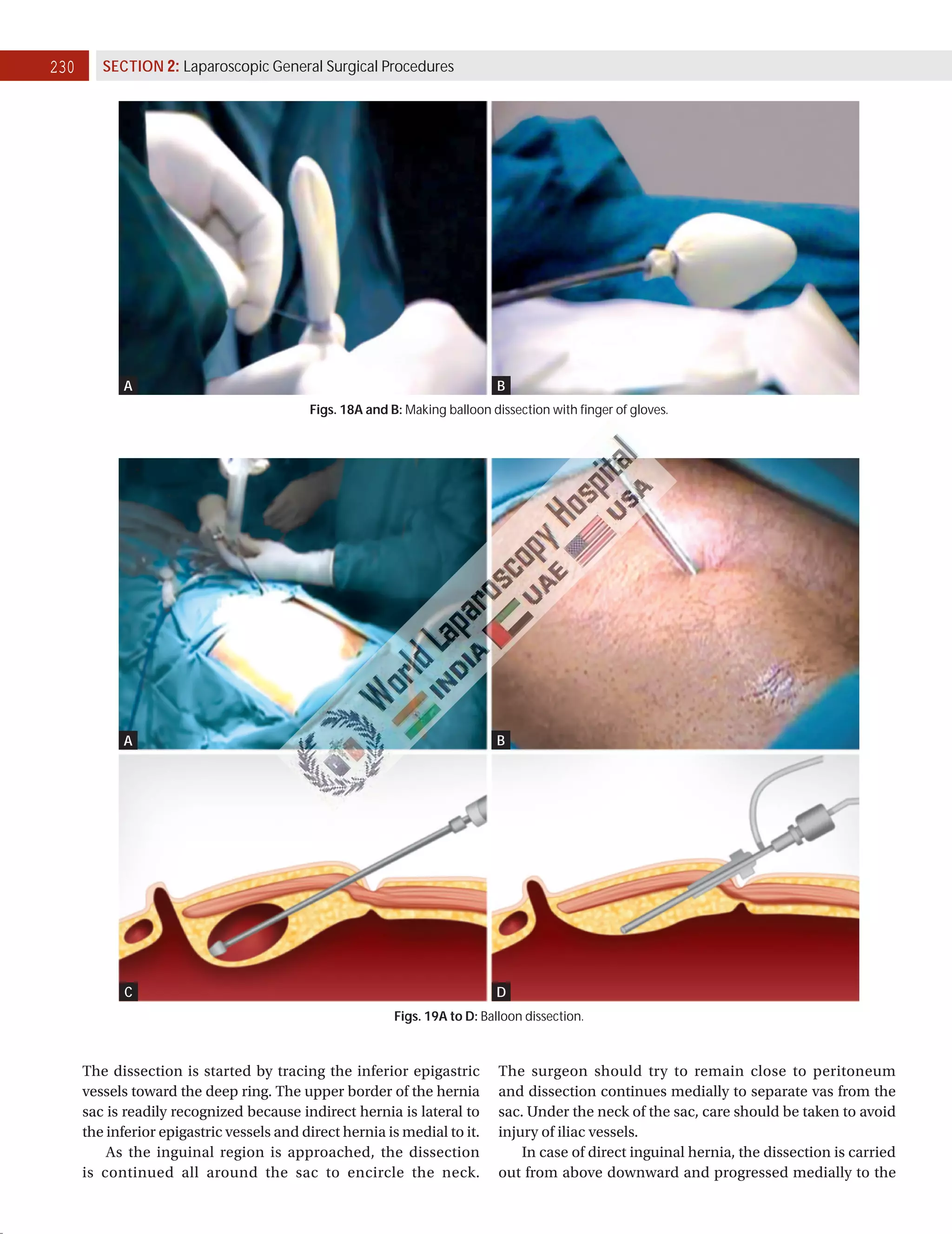 Laparoscopic Repair of Hiatus Hernia | PDF