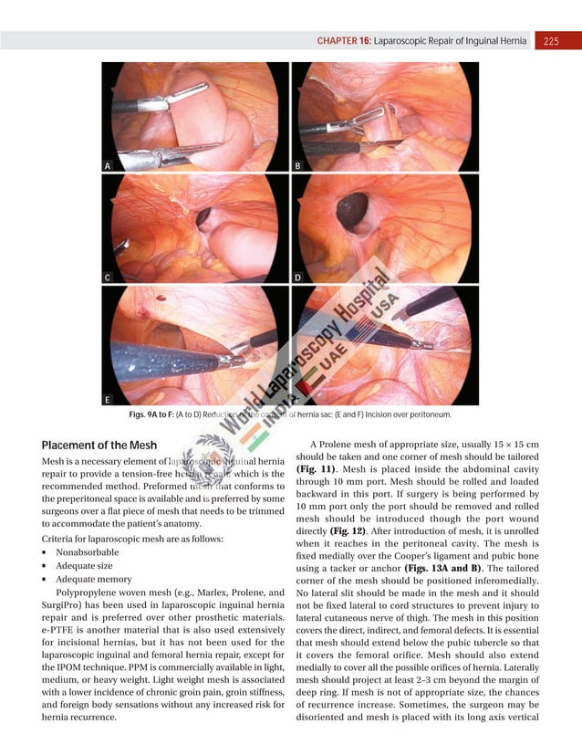 Laparoscopic Repair of Hiatus Hernia | PDF