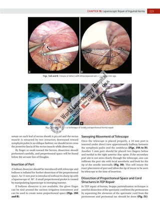 Laparoscopic Repair of Inguinal Hernia at WLH | PDF
