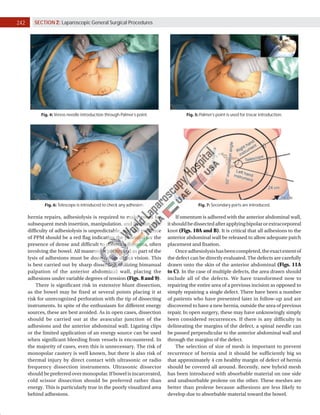 Laparoscopic Repair of Ventral Hernia at WLH | PDF