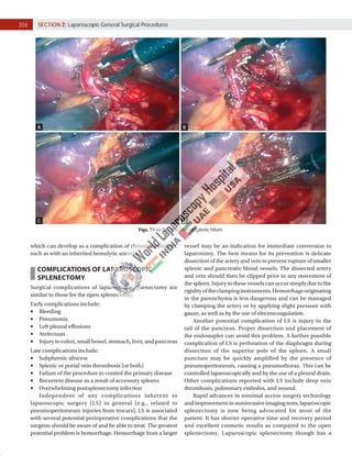 Laparoscopic Splenectomy at World Laparoscopy Hospital | PDF