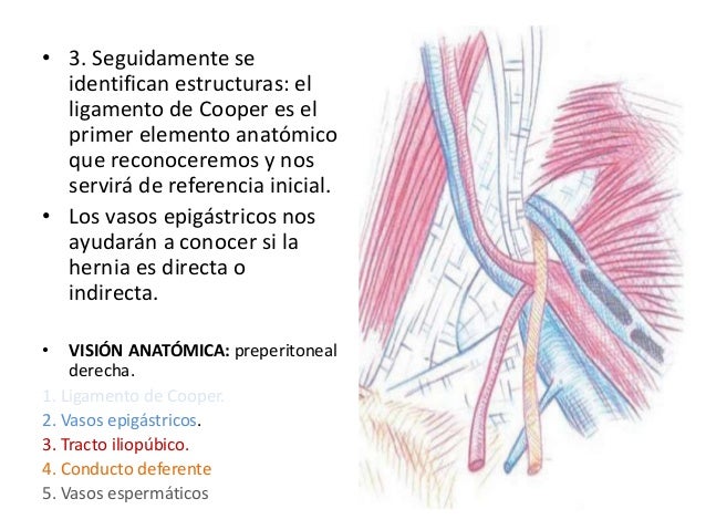 Laparoscopica hernia inguinal ppt.....