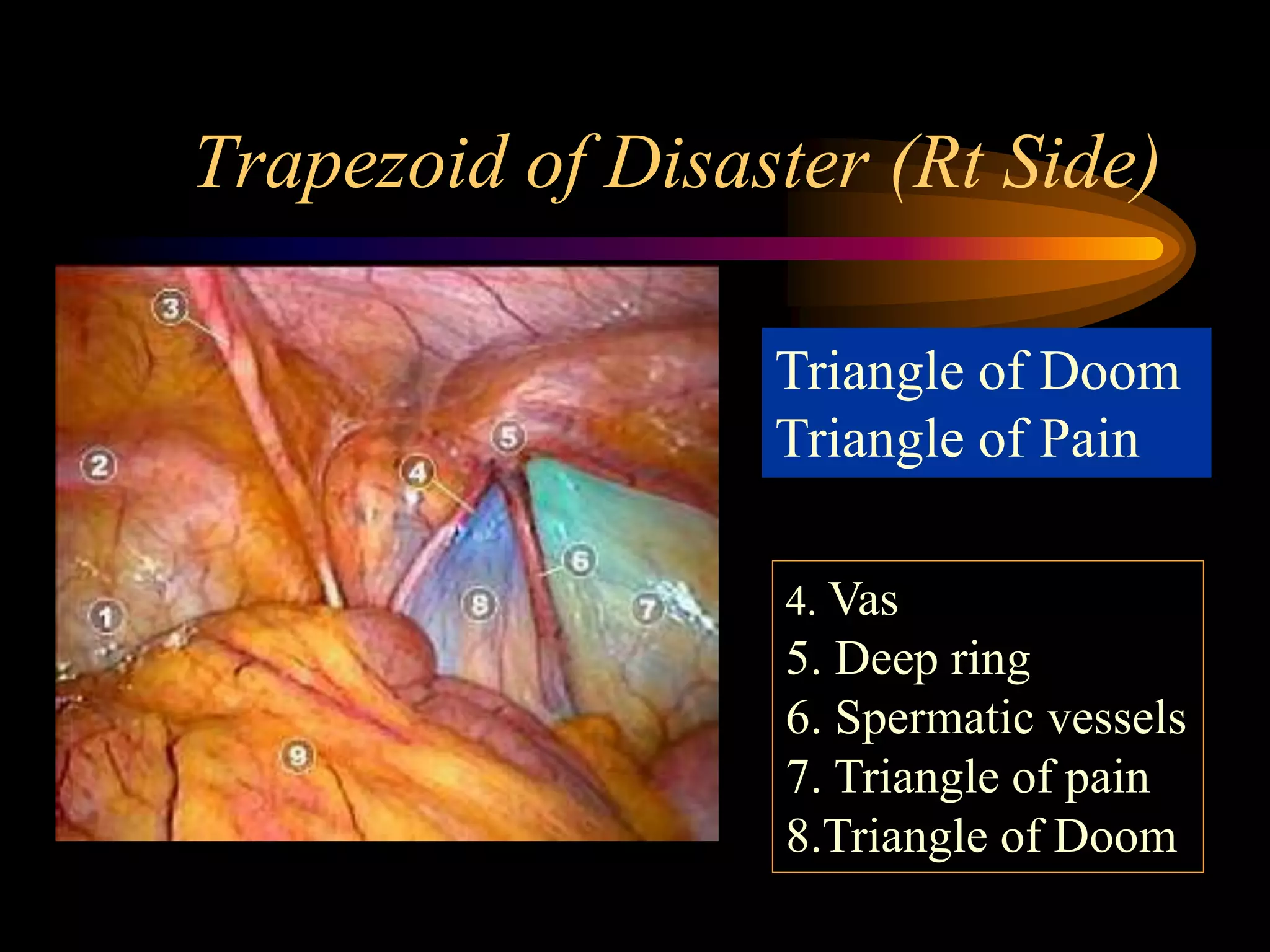 Laparoscopic anatomy of inguinal canal | PPTX