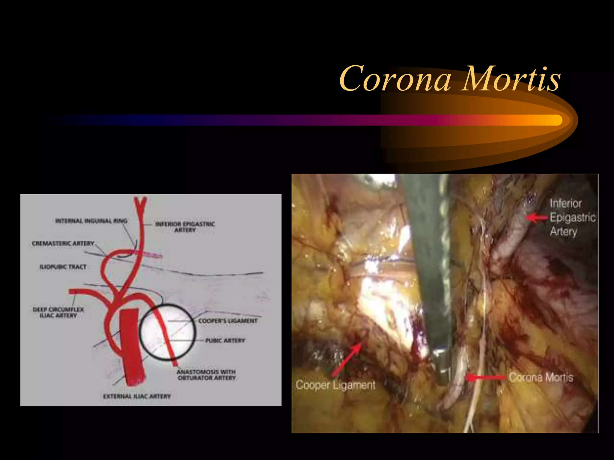 Laparoscopic anatomy of inguinal canal | PPTX