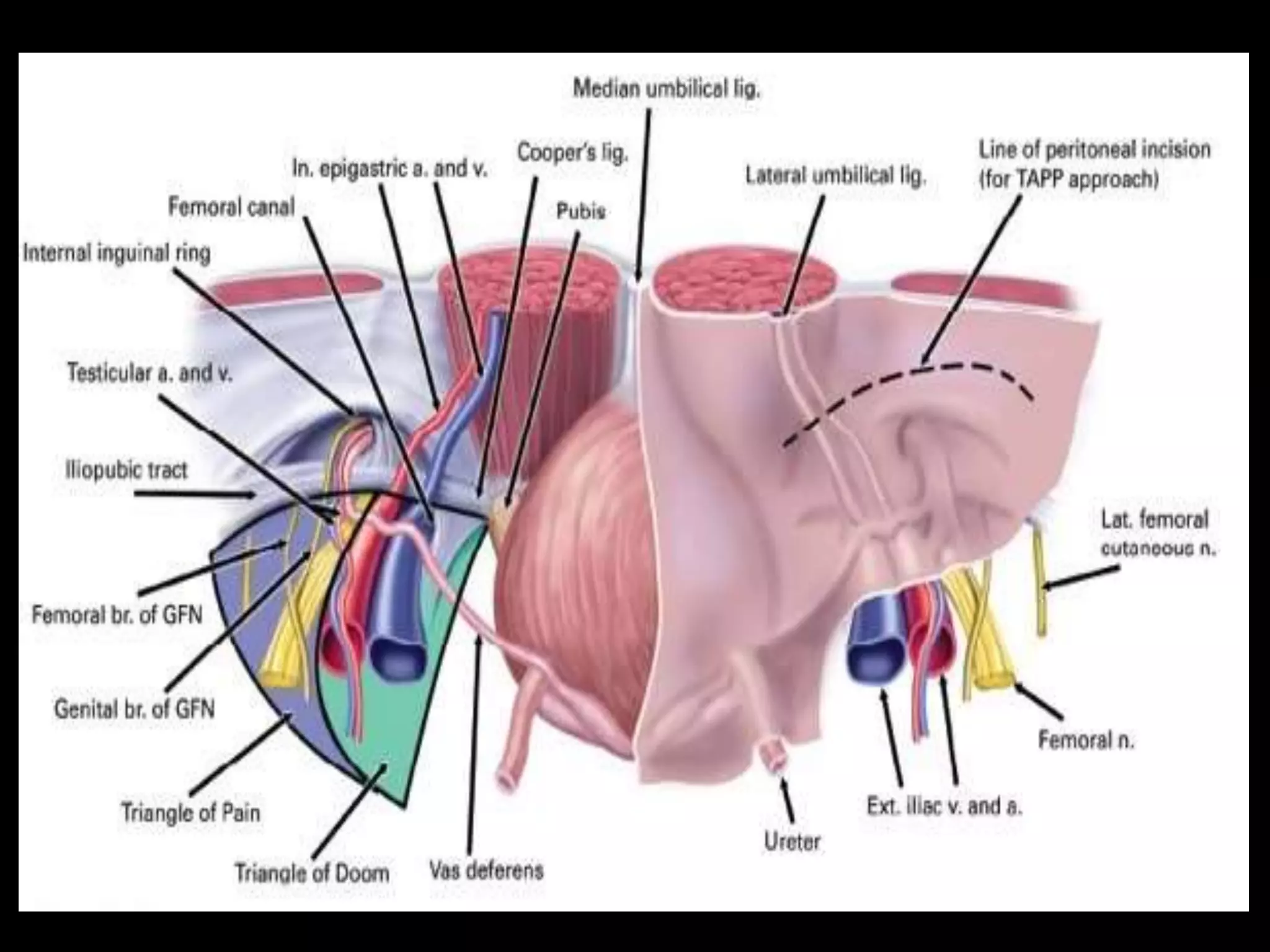 Inguinal Hernia Anatomy Laparoscopic