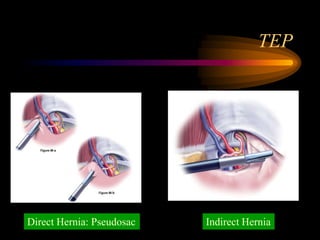 Laparoscopic anatomy of inguinal canal | PPT