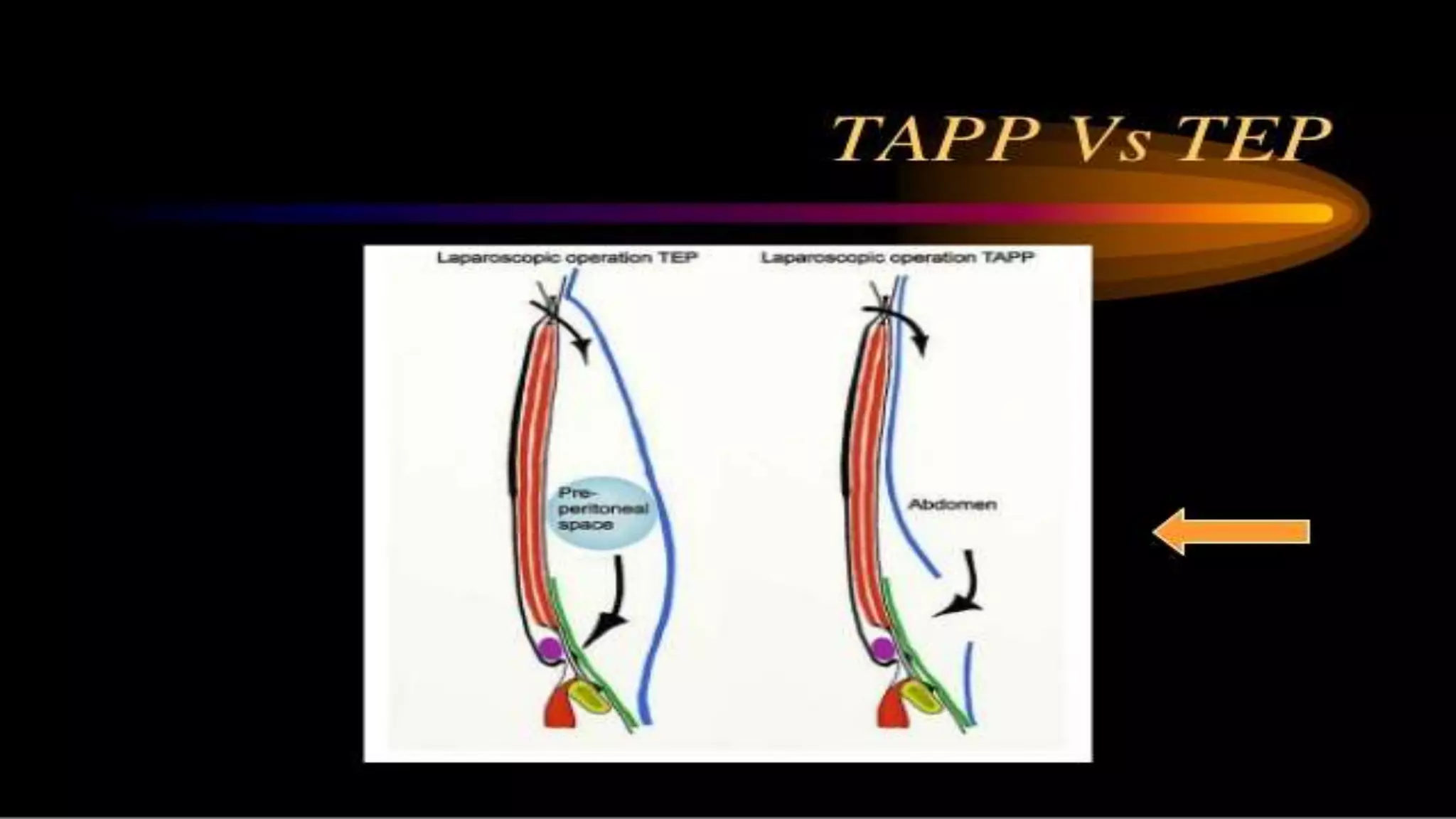 Laparoscopic anatomy of inguinal hernia | PPTX