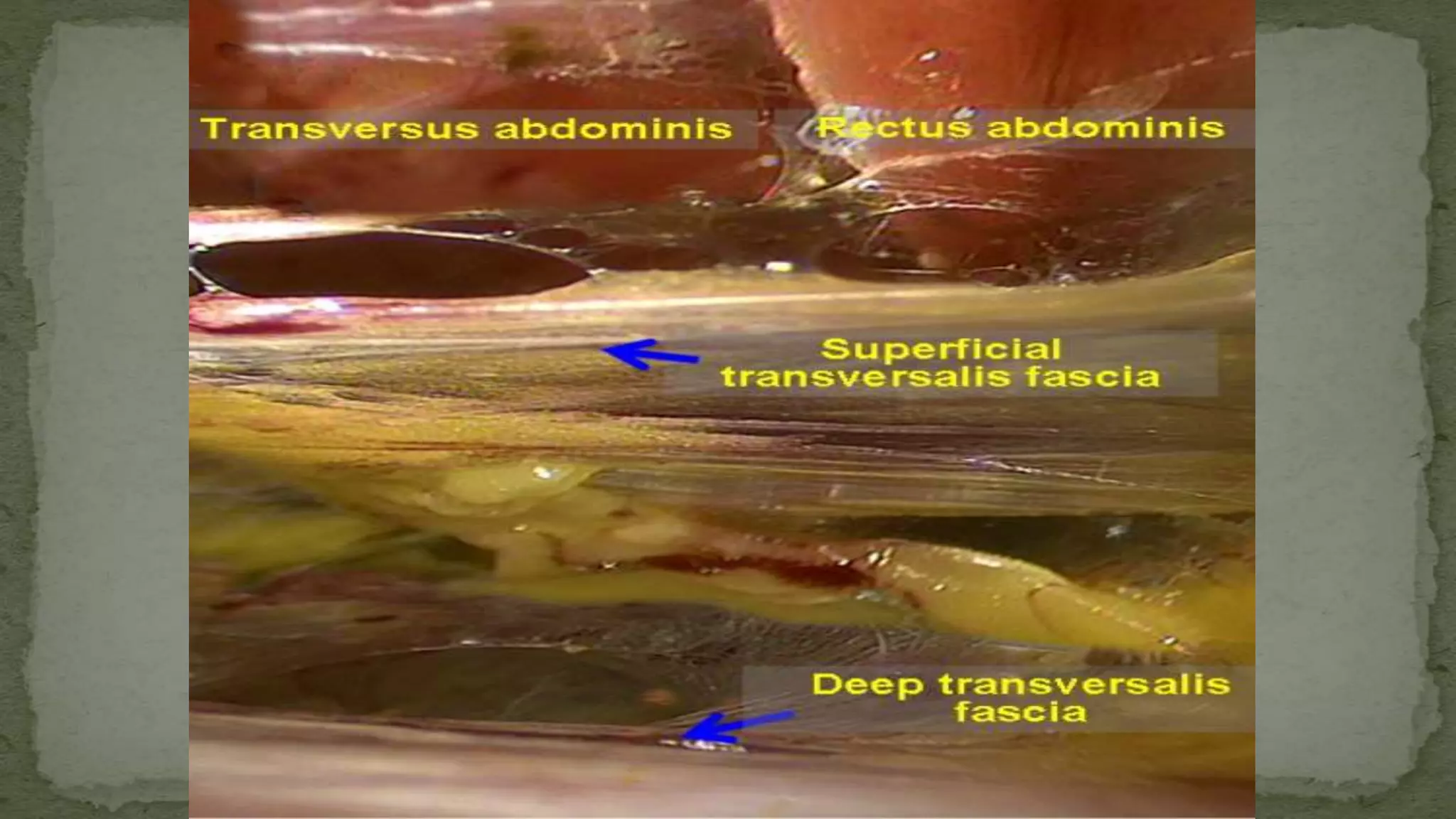 Laparoscopic anatomy of inguinal hernia | PPTX