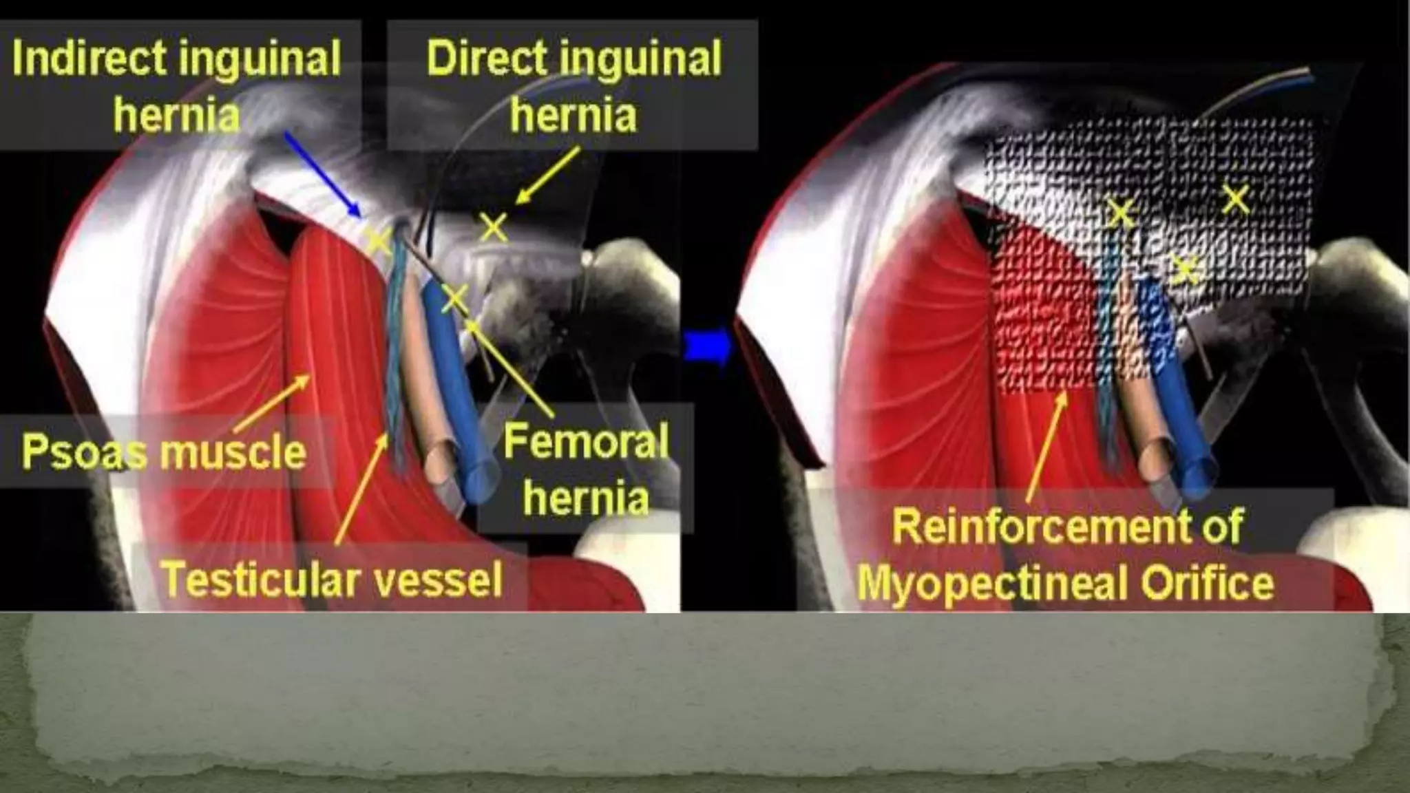 Laparoscopic anatomy of inguinal hernia | PPTX