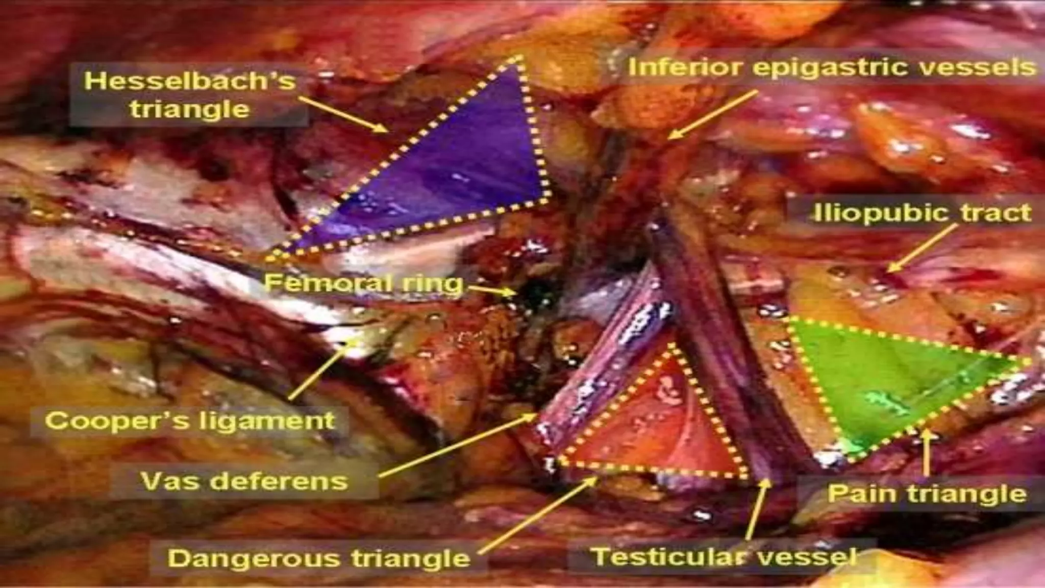 Laparoscopic anatomy of inguinal hernia | PPTX