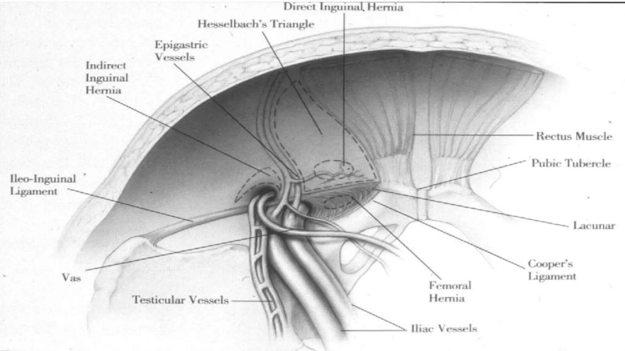Laparoscopic Inguinal Hernia Anatomy Hernia Inguinal Hernia