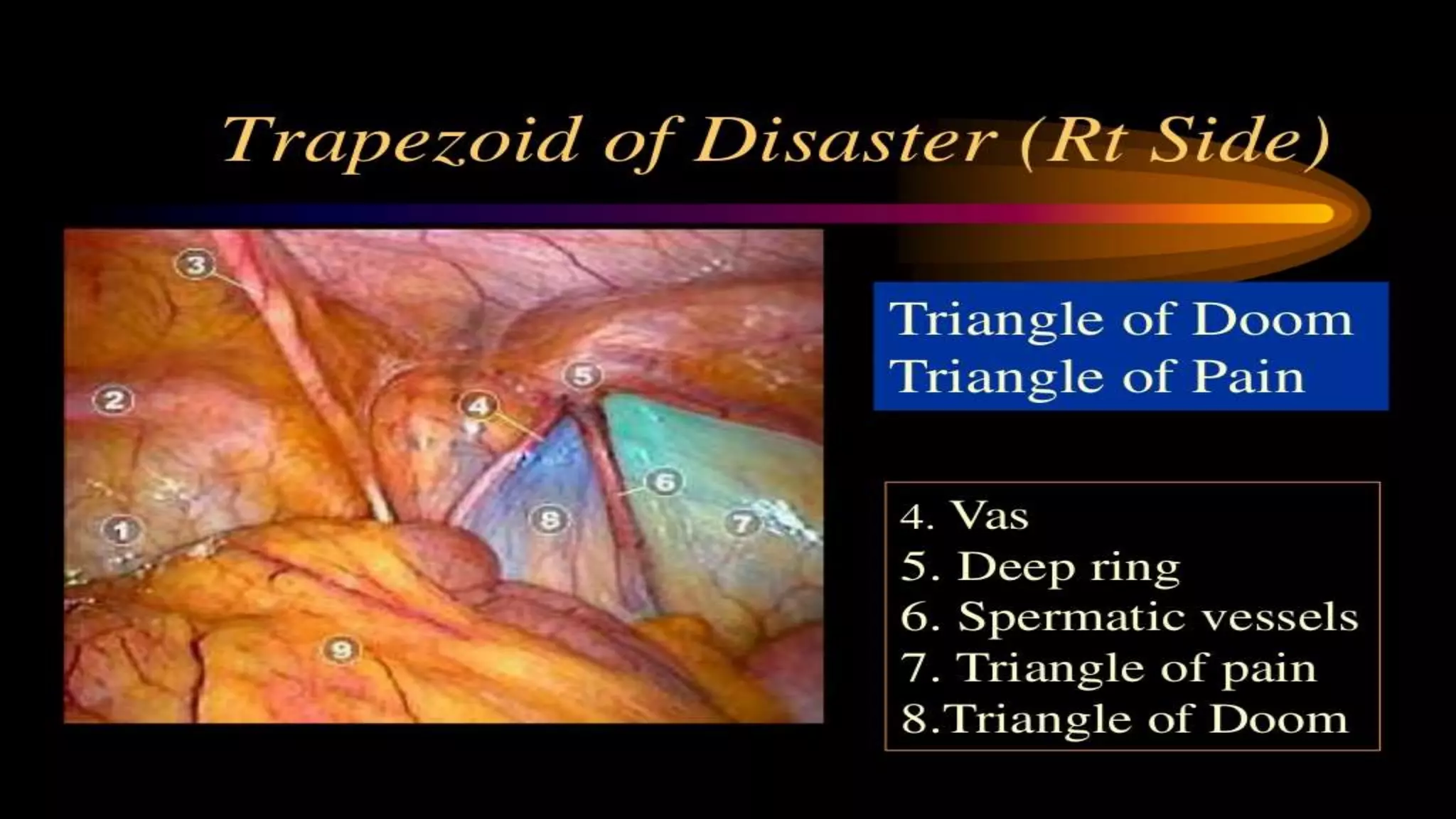Laparoscopic anatomy of inguinal hernia | PPTX