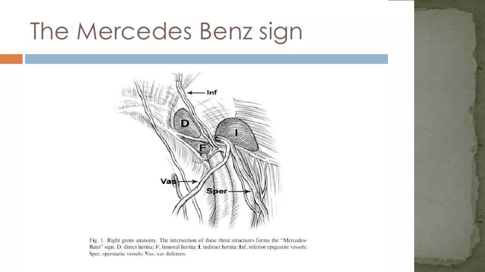 Laparoscopic anatomy of inguinal hernia | PPTX