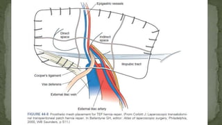 Laparoscopic anatomy of inguinal hernia | PPTX