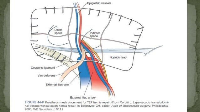 Laparoscopic anatomy of inguinal hernia | PPTX | Pregnancy ...