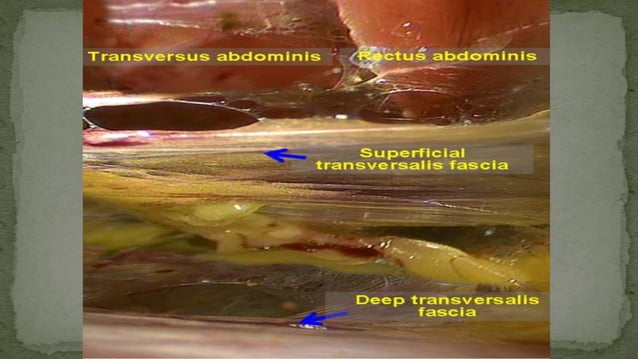 Laparoscopic anatomy of inguinal hernia | PPTX | Pregnancy ...