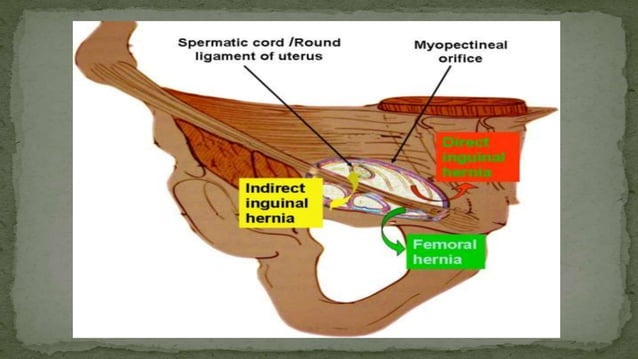 Laparoscopic anatomy of inguinal hernia | PPTX | Pregnancy | Reproductive Health