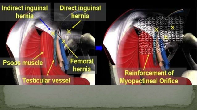 Laparoscopic anatomy of inguinal hernia | PPTX | Pregnancy ...