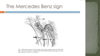 Laparoscopic anatomy of inguinal hernia | PPTX
