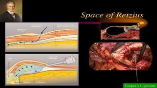 Laparoscopic anatomy of inguinal hernia | PPTX