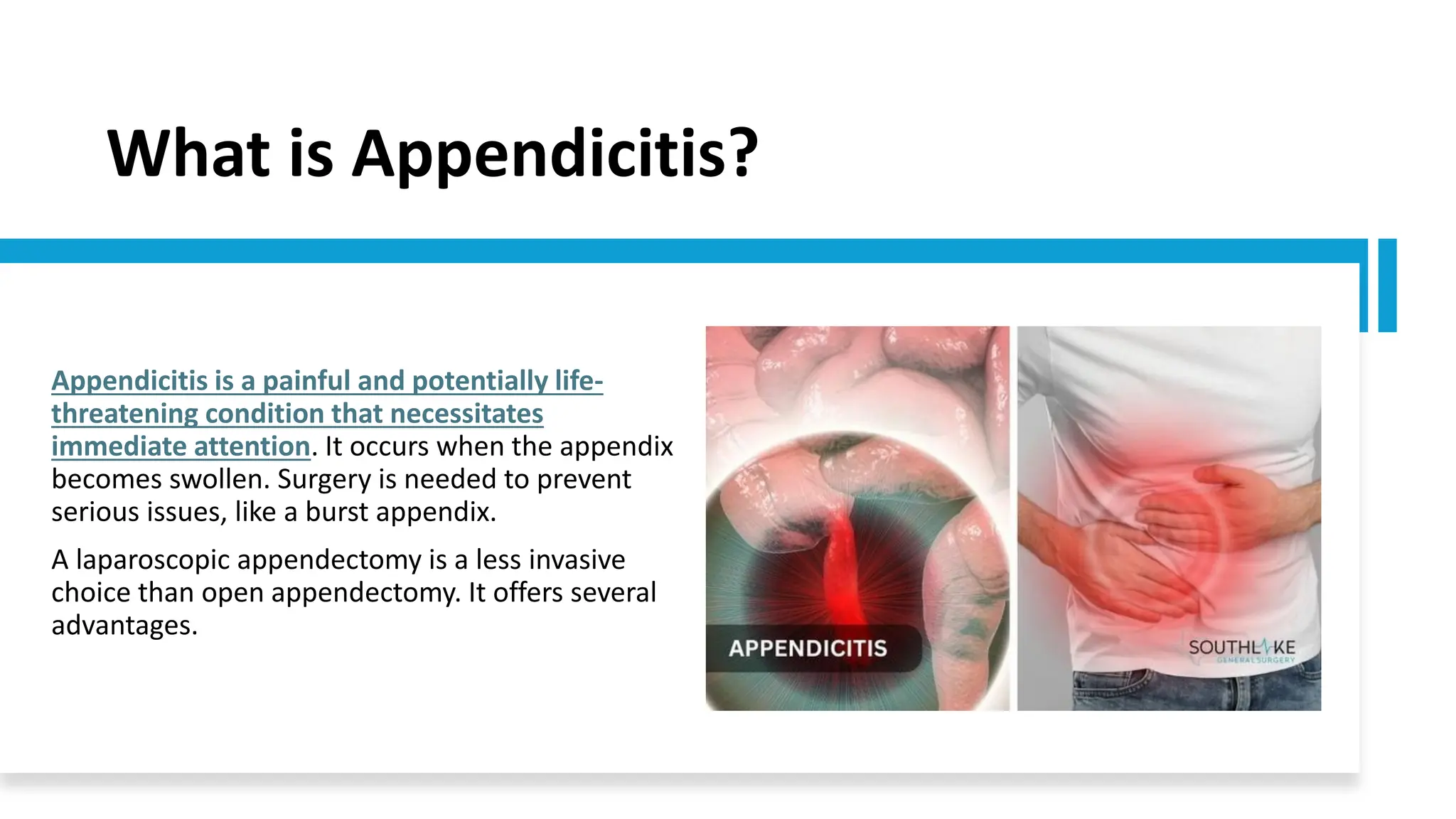 Laparoscopic Appendectomy Overview- By Dr Valeria Simone MD.pdf