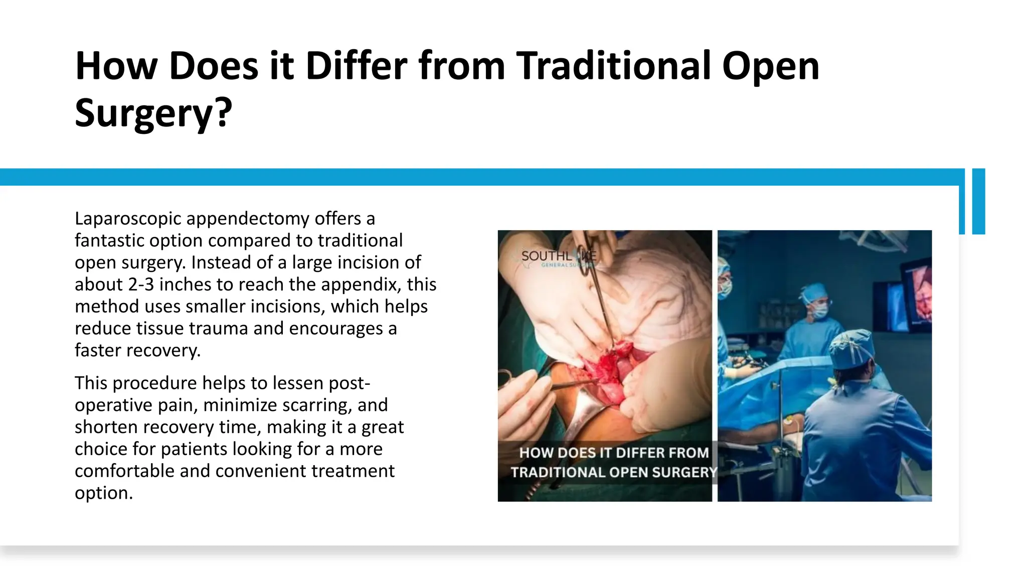 Laparoscopic Appendectomy Overview- By Dr Valeria Simone MD.pdf